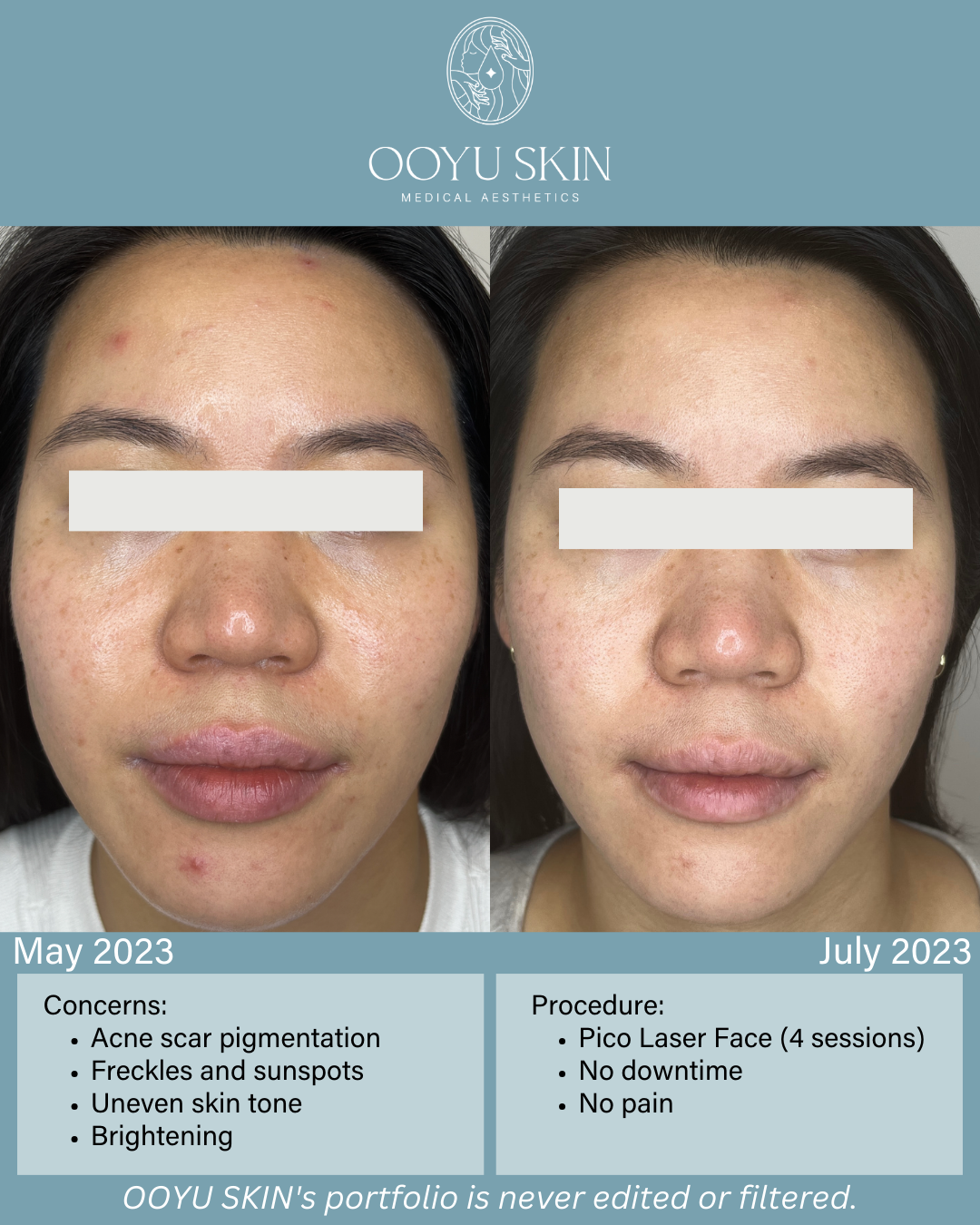 Laser Toning Face - ooyuskin.com