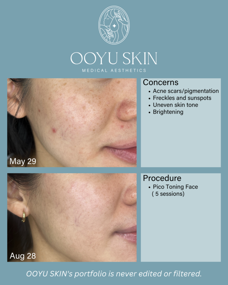 Pico Toning Face Edmonton - ooyuskin.com